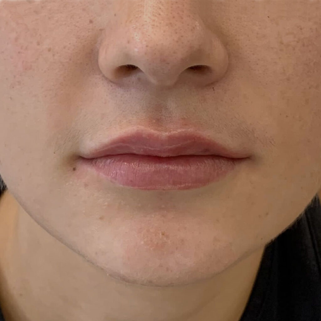 Perfilado de labios con ácido hialurónico en Barcelona 👄